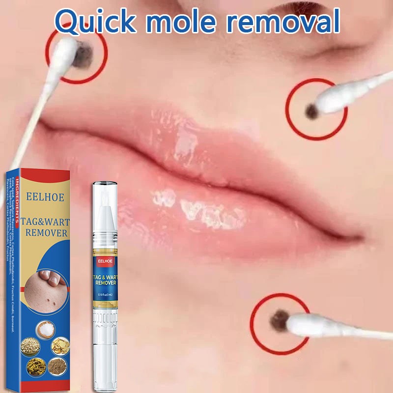 Ubat buang kutil ketuat tahi lalat biji kolestrol Skin Tag Mole Ketuat ...