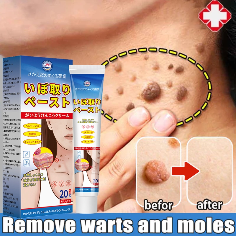 Wart remover Ubat ketuat Skin tag remover 20g Flat warts/filiform warts/genital warts/common ...