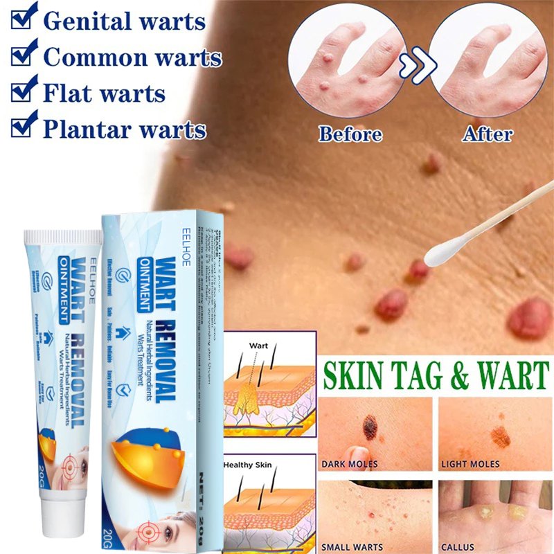 Warts Remover Ointment Ubat buang kutil ketuat tahi lalat biji ...
