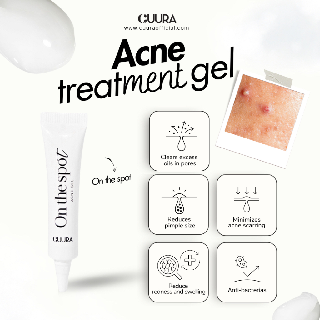 CUURA On-The-Spot ( Acne Treatment Gel ) Skincare Treatments (Gel ...