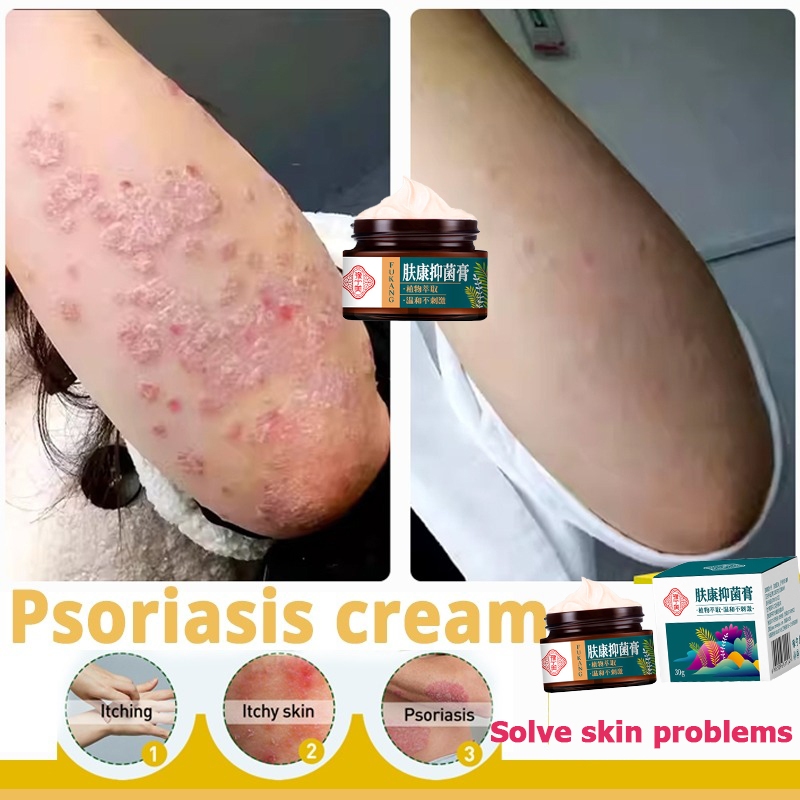 Ubat gatal kemaluan Ubat gatal kulit krim gatal antifungal cream ...