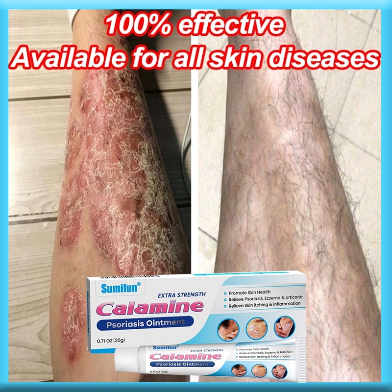Krim gatal kulit eczema cream psoriasis cream itchy skin cream ubat ...