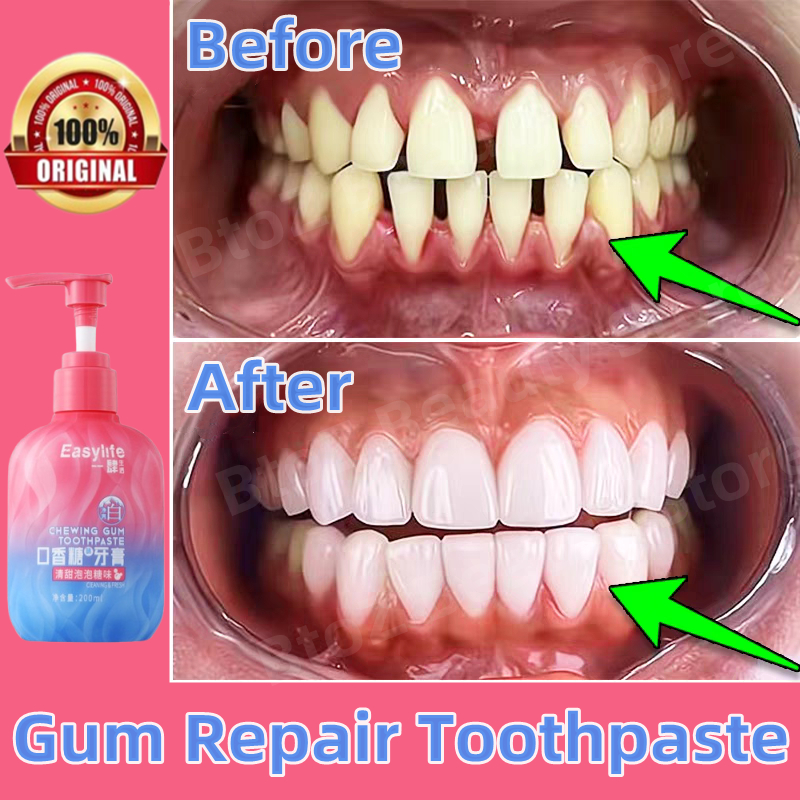 Gum repair toothpaste Perbaikan Gusi Gigi Kecil Longgar dan Retraksi ...