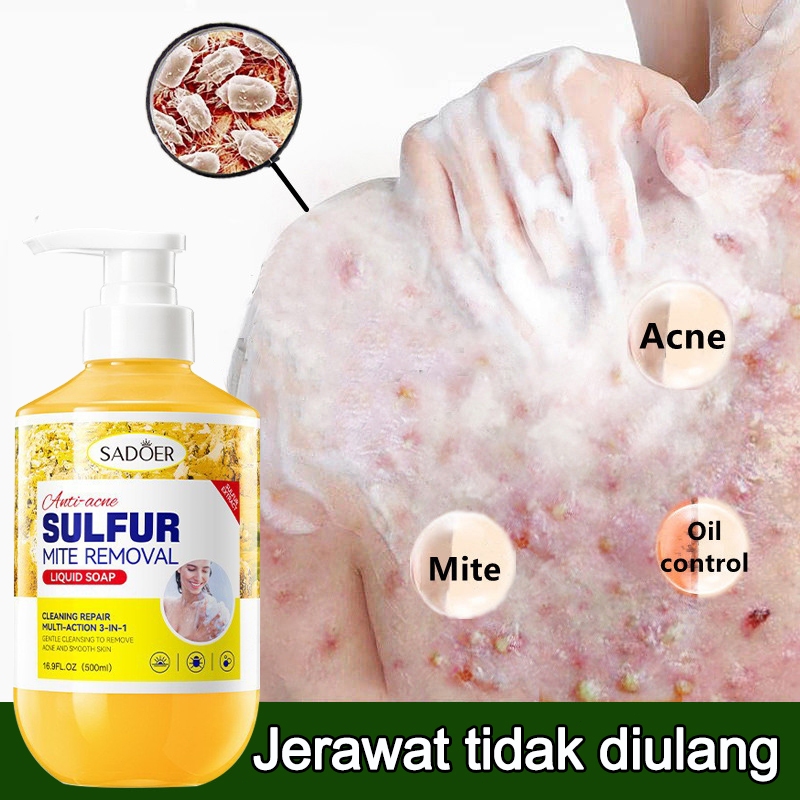 Sulfur Anti-Acne Body Wash acne body wash 500ml Back Acne Cleansing ...