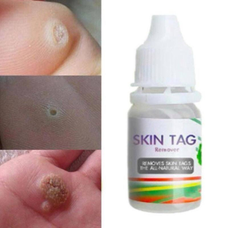 SKIN TAG REMOVER Penanggal Kutil Ketuat biji kolestrol jeragat bintik ...