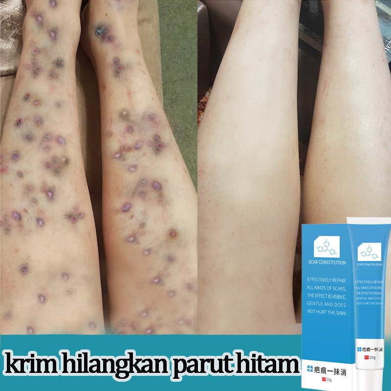krim hilangkan parut hitam ubat parut krim parut hitam Hilangkan parut ...