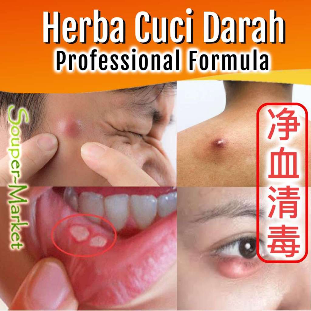 Penawar Ulser Mulut/ Bisul/ Ketumbit Mata [ 添加:穿心莲 特效配方] 解毒消炎片 清血丸 祛痘 ...