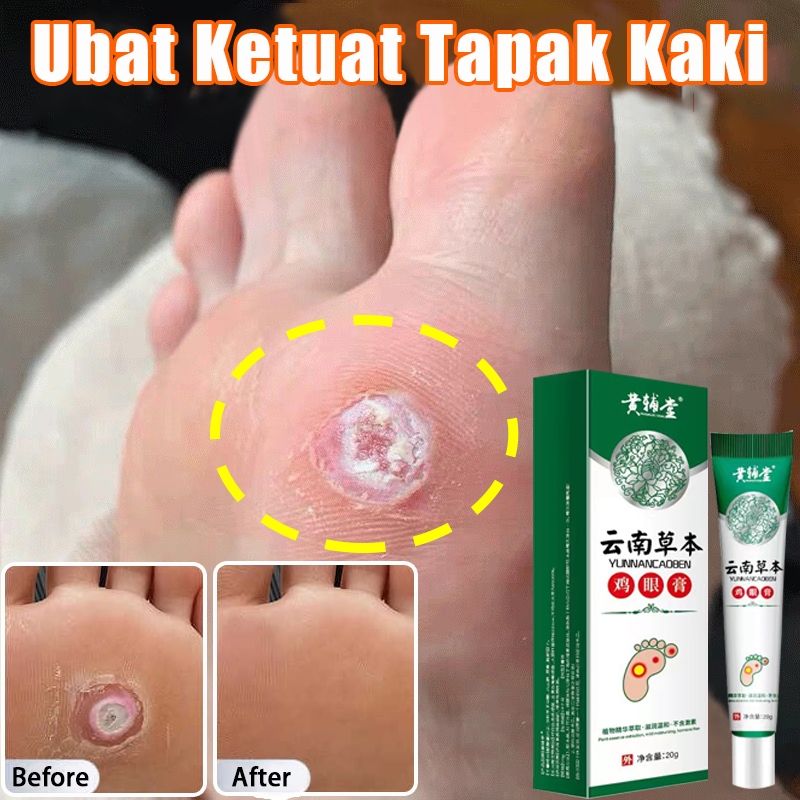 ubat ketuat tapak kaki 20g corn plaster Foot corn removal Hand corn ...