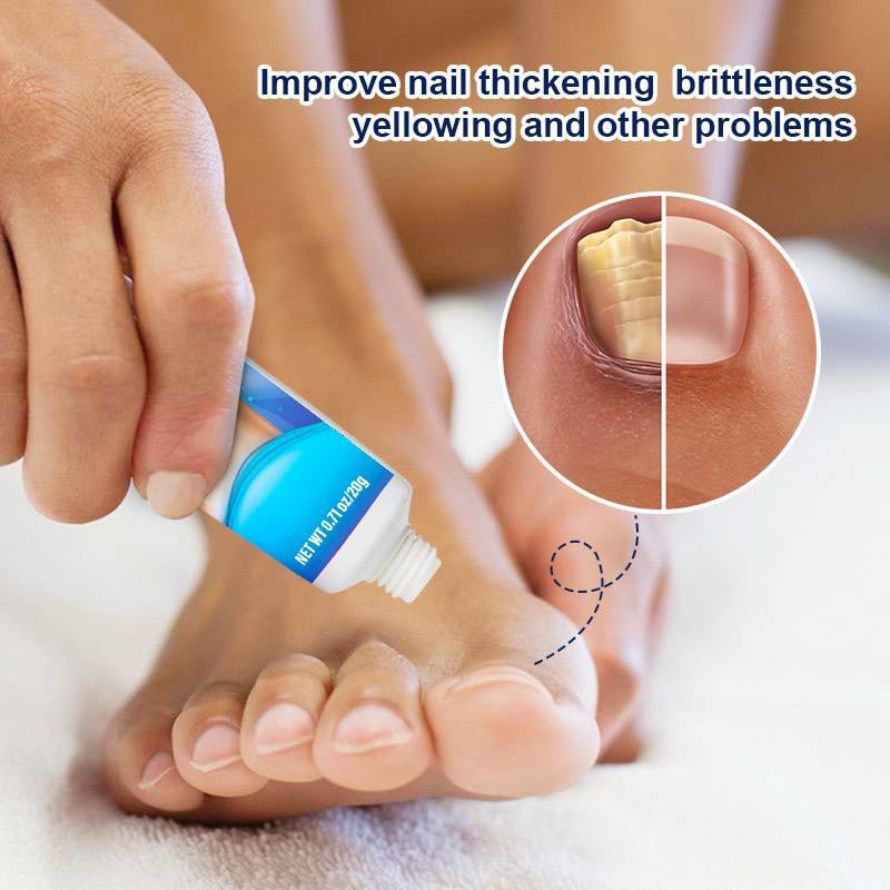 SUMIFUN NAIL FUNGUS TREATMENT CREAM rawatan kuku penghapus kulat kuku ...