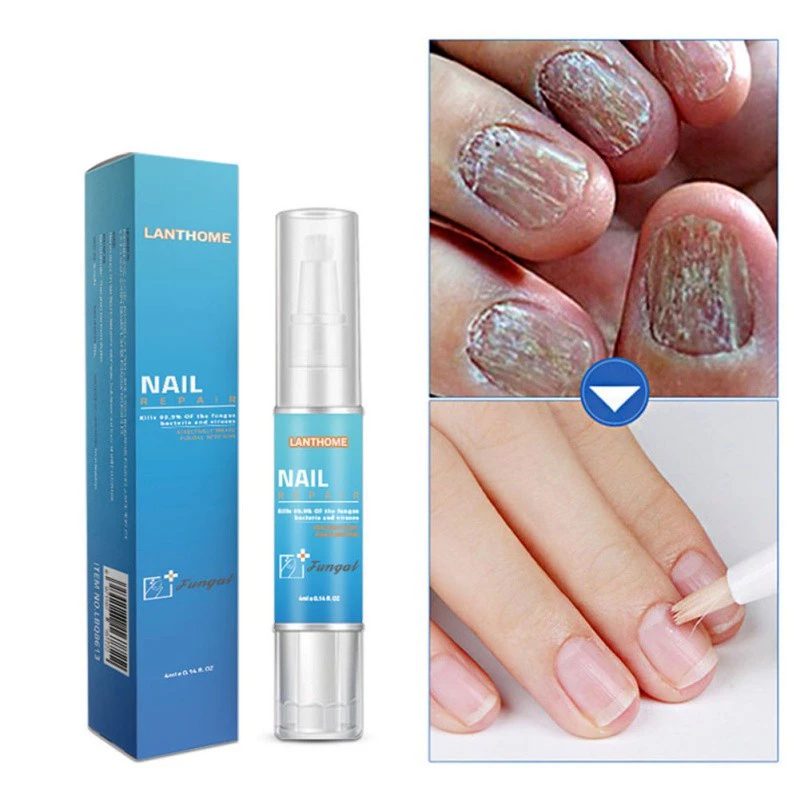 Kills 99.9% Bacteria and Fungus Nail Fungus Treatment Cream ...