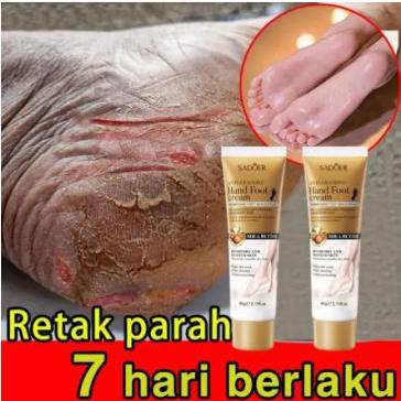 Anti wrinkle foot cream removes dead skin crusts and heel cracks ...