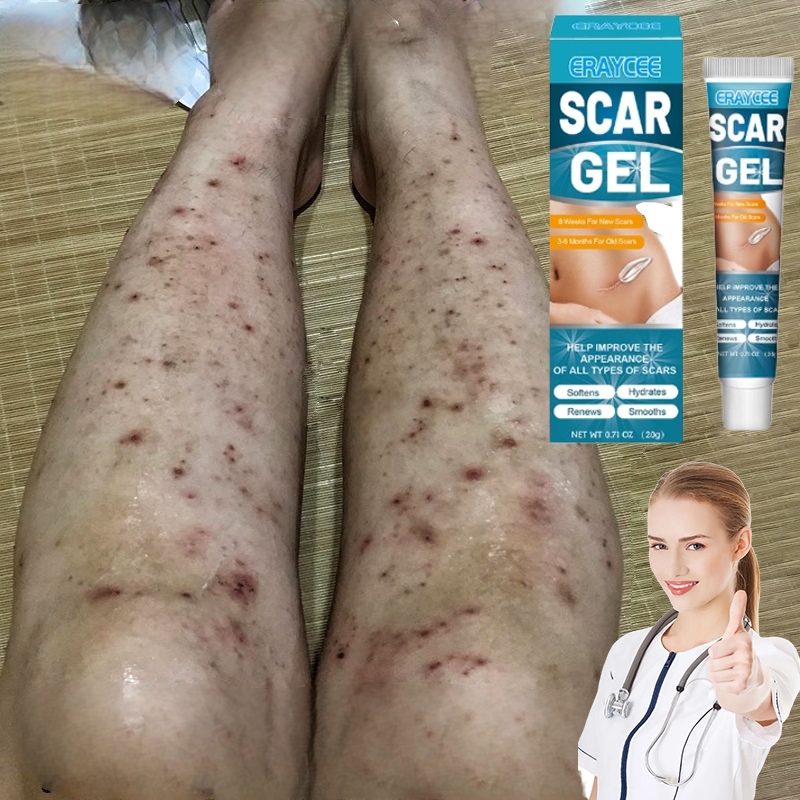 Scar removal cream Krim hilangkan parut hitam Hilangkan parut kudis ...