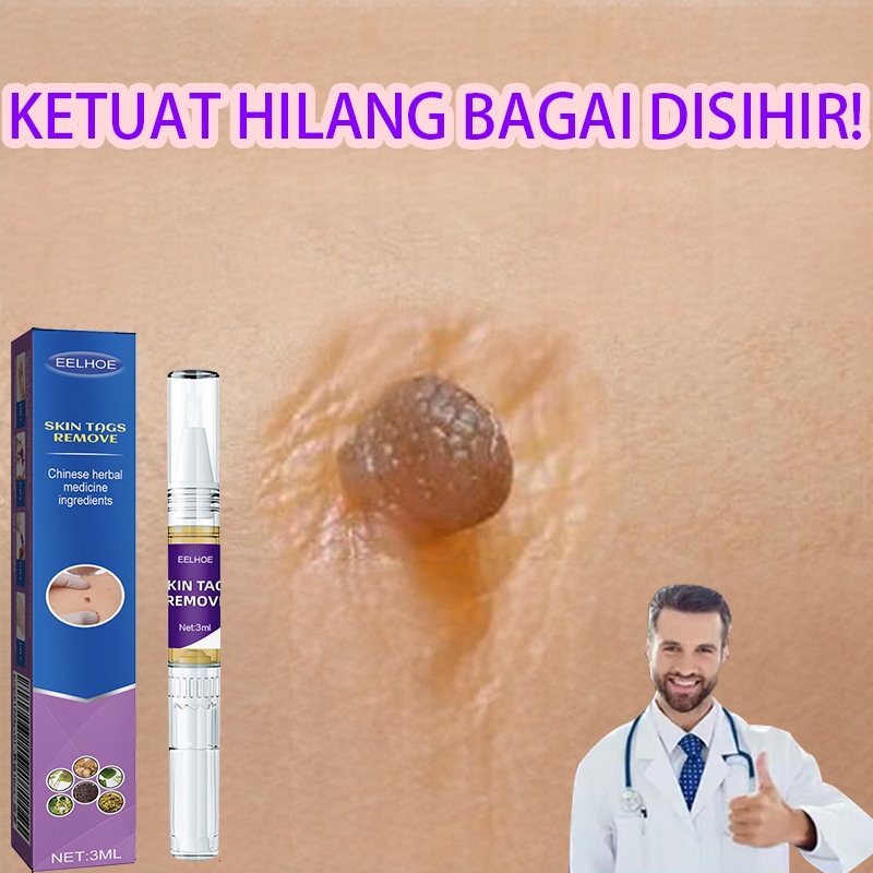Wart Remover Serum ubat ketuat Skin tag remover Mole Remover warts ...