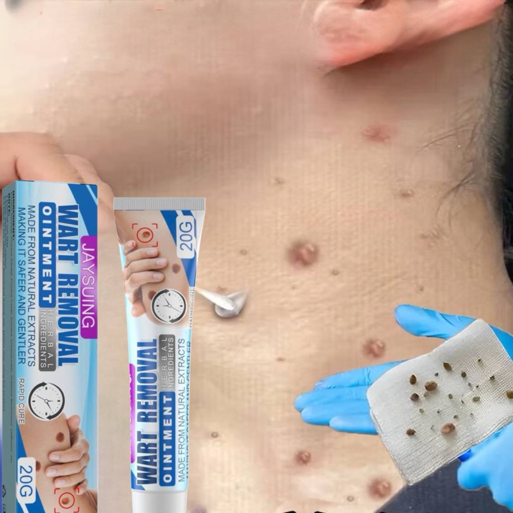 WART REMOVAL CREAM Krim Penanggal buang Ketuat / kutil bintik hitam ...