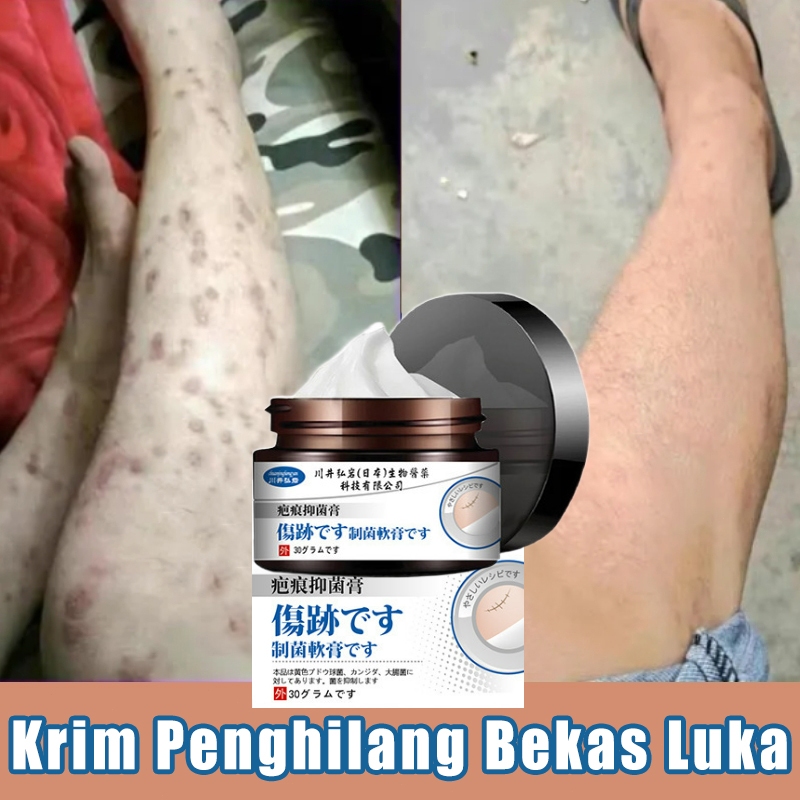 krim hilangkan parut hitam Hilangkan parut kaki Menghilangkan bekas ...