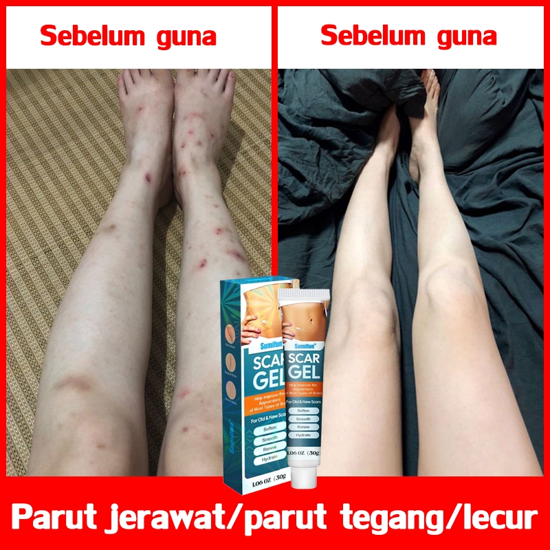 3 days removal krim hilangkan parut hitam Menghilangkan bekas luka lama ...