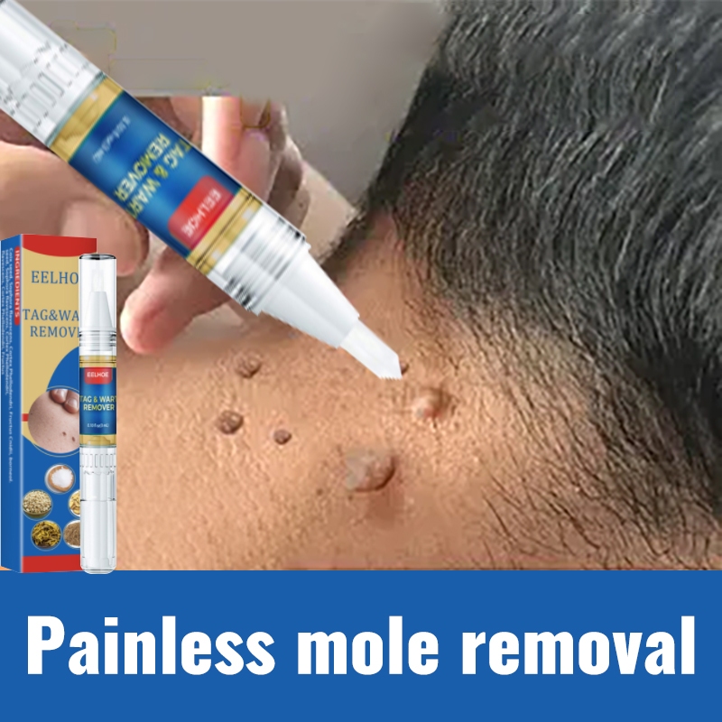 Tahi lalat remover Skin tag remover Buang tahi lalat dan kutil Buang ...