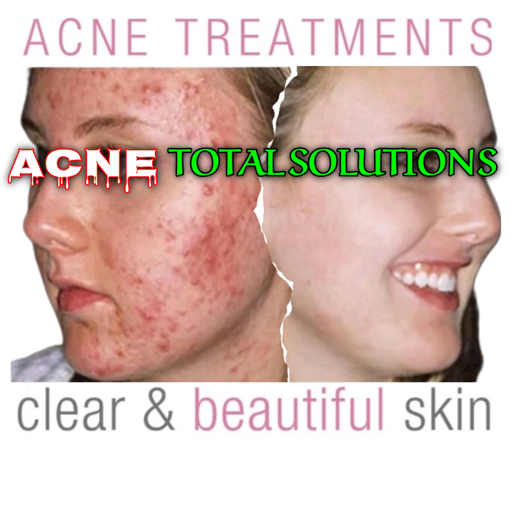 Anti BreakOut Capsules Ubat Jerawat Flawless Skin Licin Berseri Rawat ...