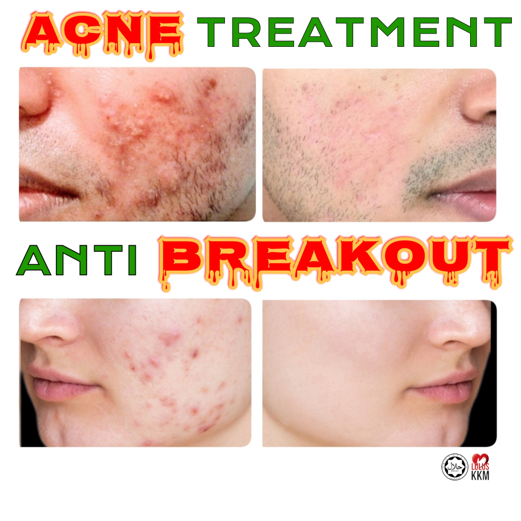 AcneCare Anti Jerawat Acne Solutions Rawat Jerawat Anti BreakOut ...