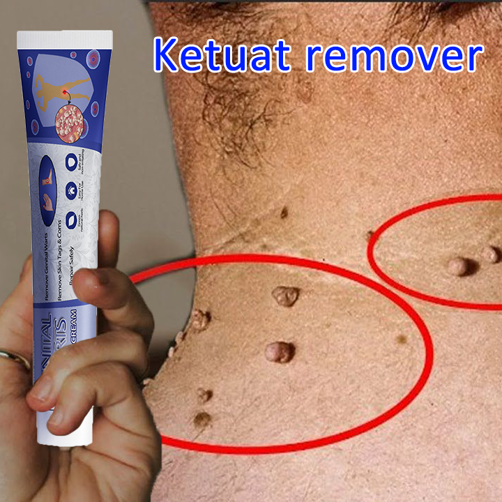 Wart remover Ubat buang kutil Skin tag remover Mole Removal Wart Cream ...