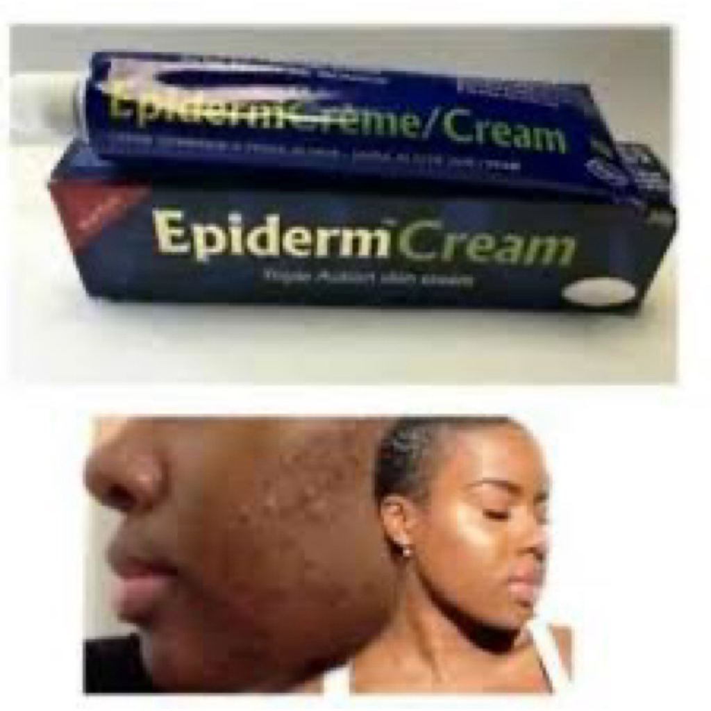Epiderm Cream Triple Action Skin Cream 30g | 💯% Authentic | 🔥In Stock🔥 ...