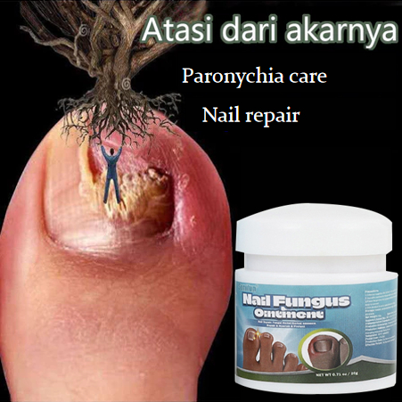 ubat kuku rosak ingrown toenail nail fungus treatment ubat kuku cekam ...