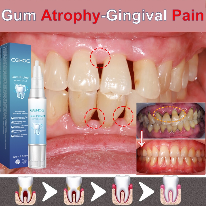 Gum Instant Soothing Gel Receding Gums Therapy Inflammation Treatment ...
