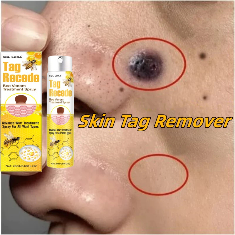 Tag Recede Bee Venom Spary Wart Remover buang tahi lalat Ubat kutil ...