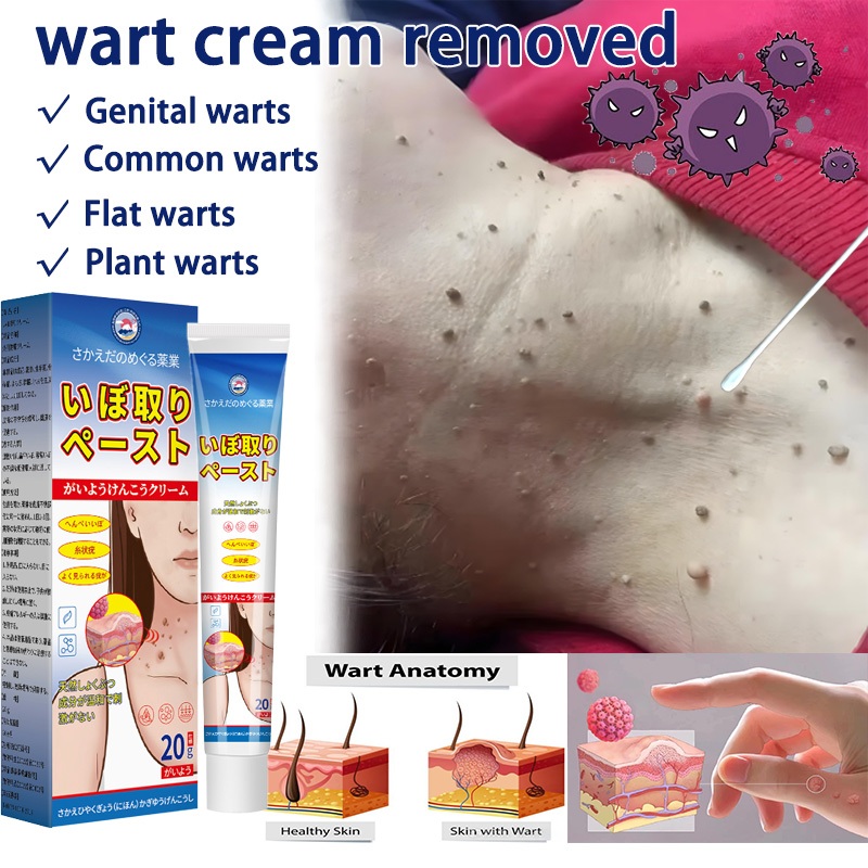 wart remover/warts removal cream/genital warts 20g neck wart repair ...