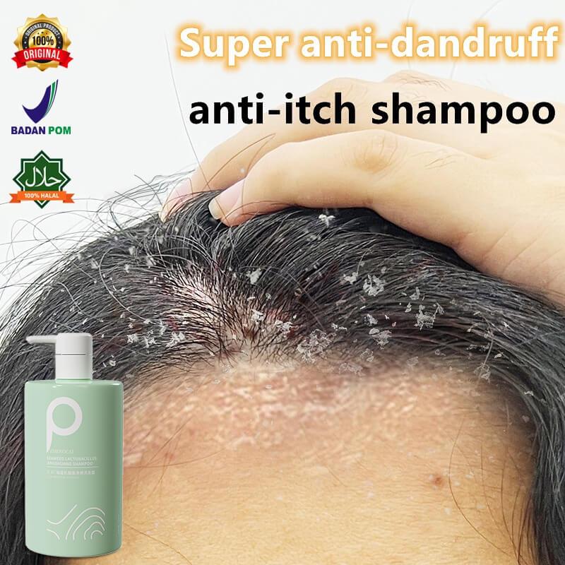 Anti dandruff Psoriasis shampoo syampoo gatal kepala ubat kelemumur ...