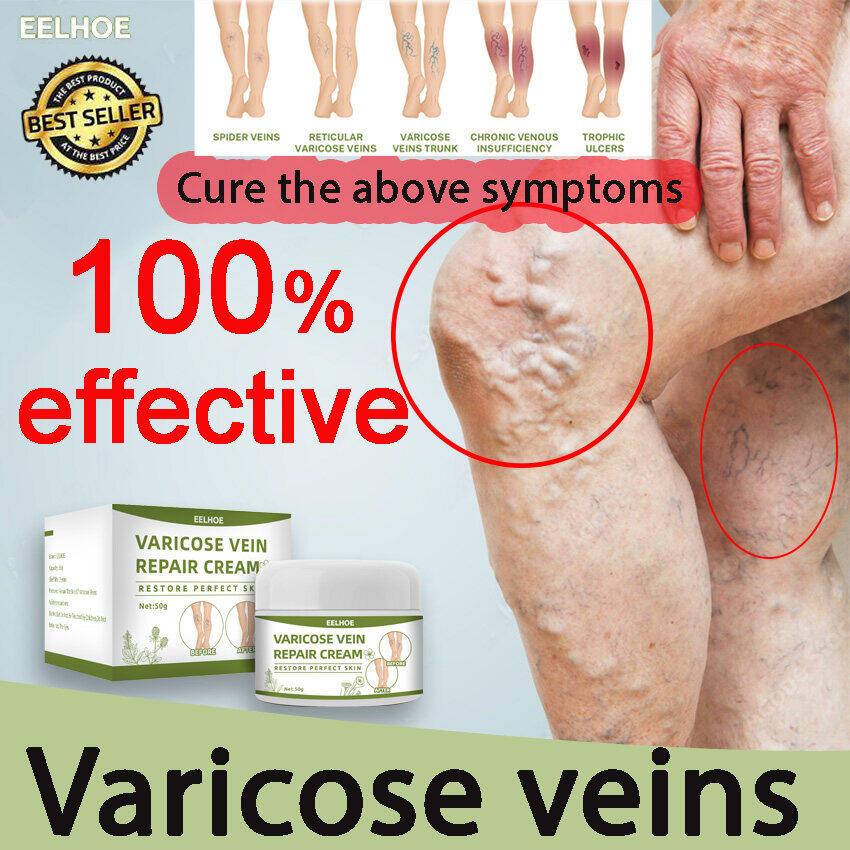 Varicose Veins Cream hilangkan urat bengkak urat angin urat timbul obat ...