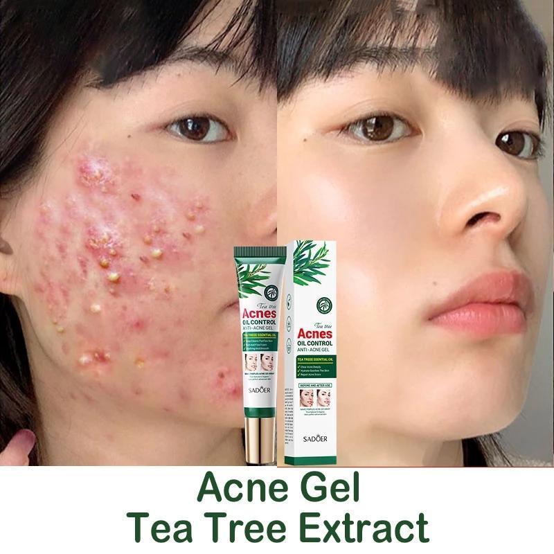 Tea Tree Acne Removing Cream 20g Tea Tree essence Acne Removing&Oil ...