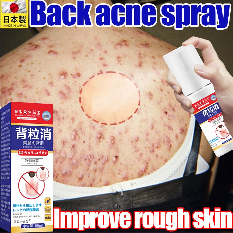 back acne spray jerawat badan belakang acne body spray back acne body ...