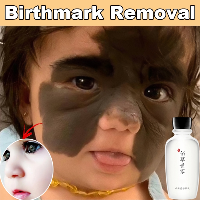 natural birthmark remover black red brown birthmarks solution melanin ...
