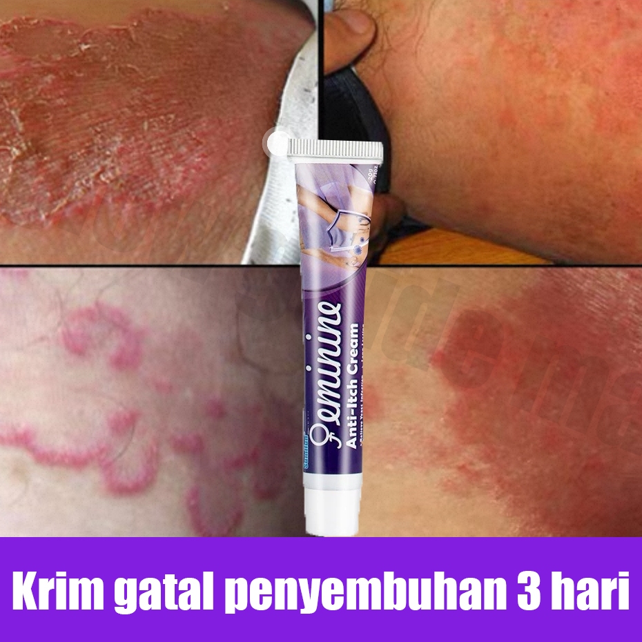 ubat gatal kulit ubat kurap ubat gatal kemaluan wanit psoriasis eczema ...