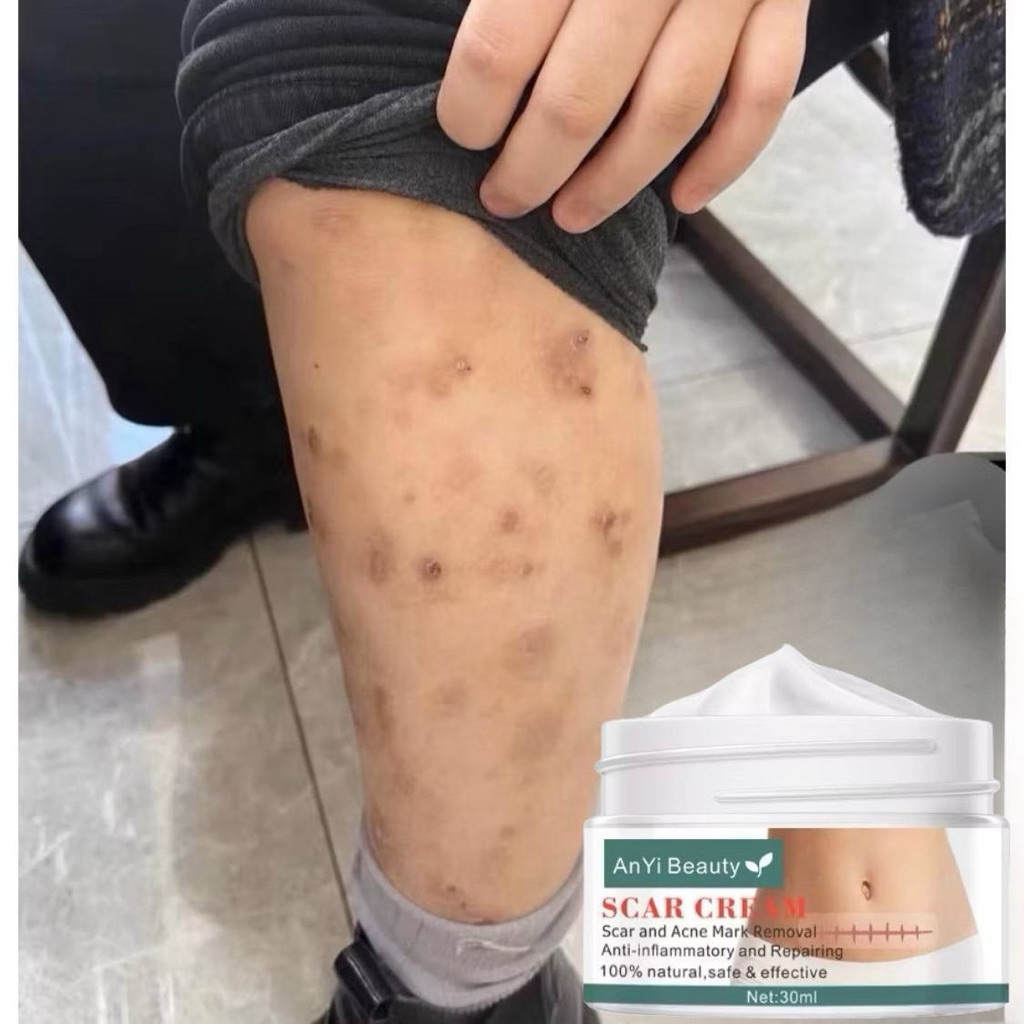 ANYI SCAR STRETCH MARKS CREAM Krim anti parut penghilang parut selulit ...
