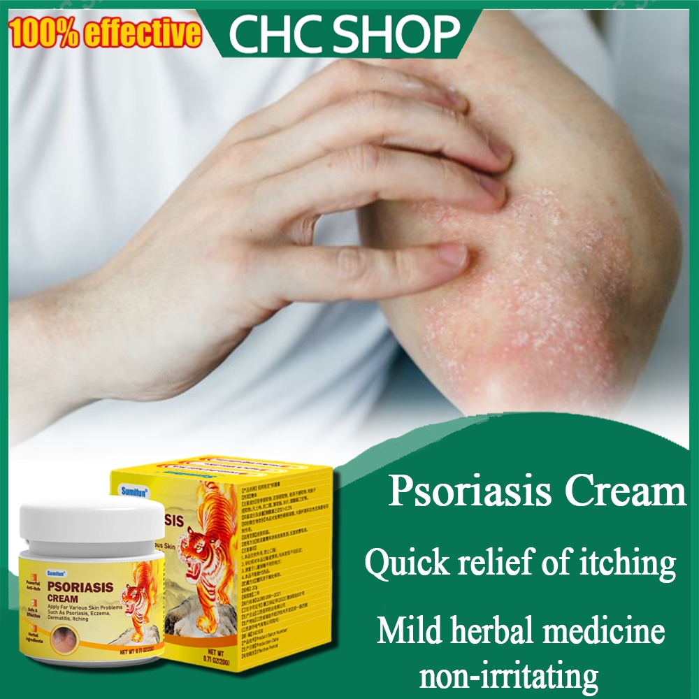 Psoriasis Cream Antifungal cream ubat gatal kulit tiger balm Itchy Skin ...