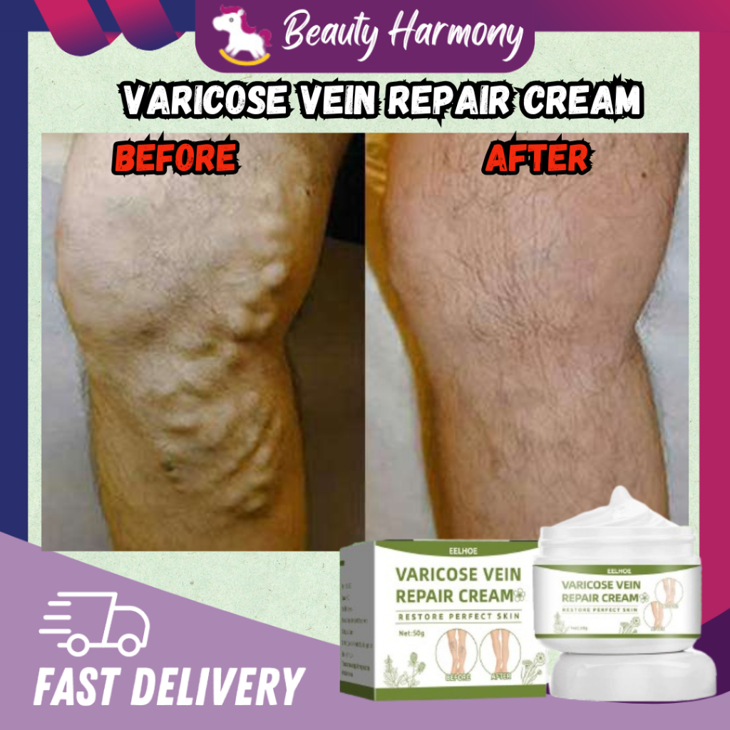 EELHOE Varicose Vein Cream Swelling Earthworm Pain Red Blood Silk ...