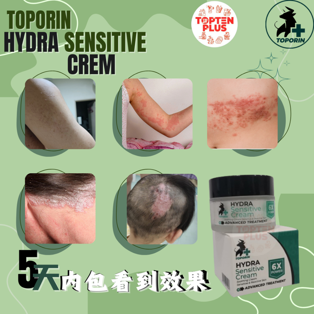 TOPORIN CREAM HYDRA SENSITIVE HAND &BODY CREAM KURAP EKZEMA CREAM Sapu ...