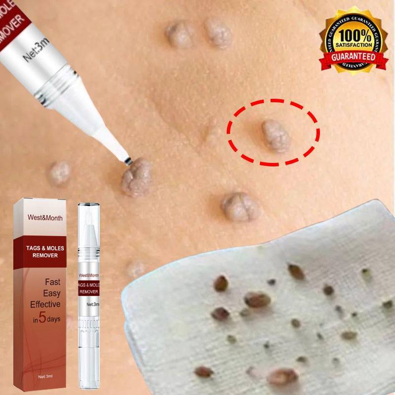 COD Tahi lalat remover 3ml Skin tag remover buang kutil ketuat tahi ...