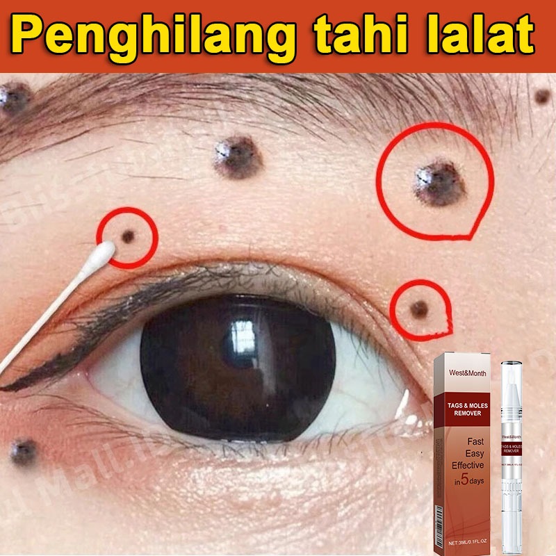 Tahi lalat remover Skin tag removal Buang tahi lalat Buang kutil dan ...