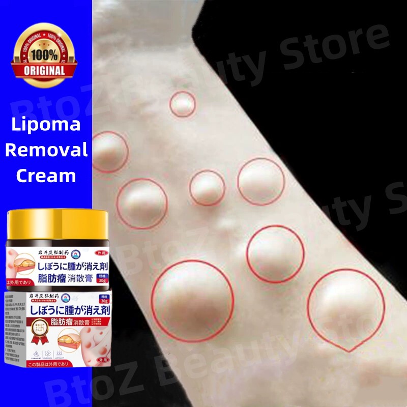Lipoma Removal Cream Original subcutaneous Lipoma Elimination Benjolan ...