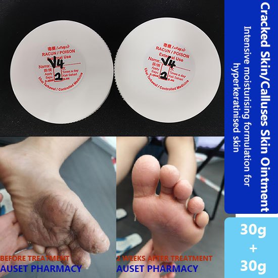 CRACKED SKIN/CALLUS/HYPERKERATINIZED SKINCARE V4 OINTMENT KULIT RETAK ...