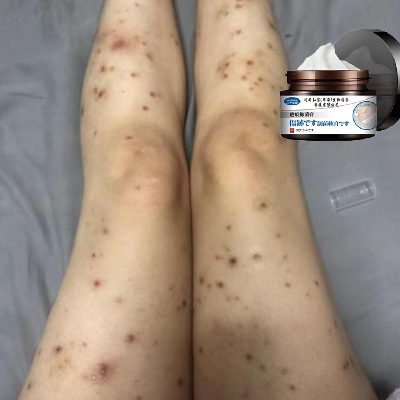 krim hilangkan parut hitam scar removal cream hilangkan parut kaki ...