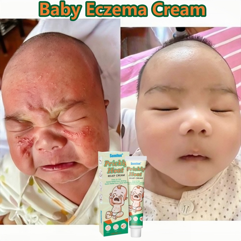 Baby eczema cream anti-itch cream Krim Gatal Kulit kering psoriasis eczema Delicate Skin Eczema ...