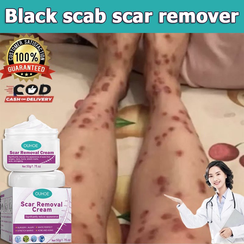 krim hilangkan parut hitam Ubat parut kaki Menghilangkan bekas luka ...