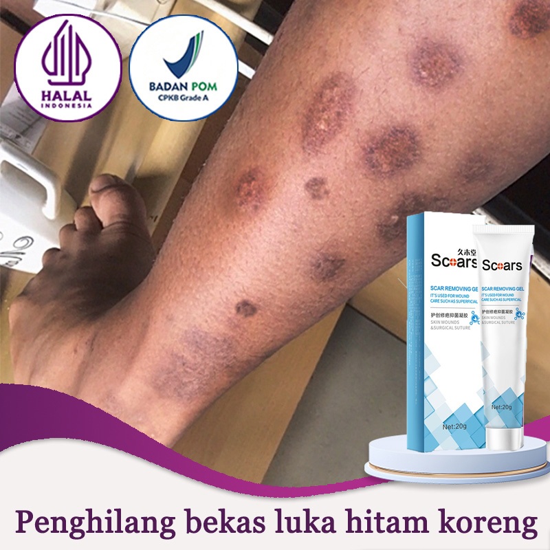 krim hilangkan parut hitam Menghilangkan bekas luka lama Ubat parut ...