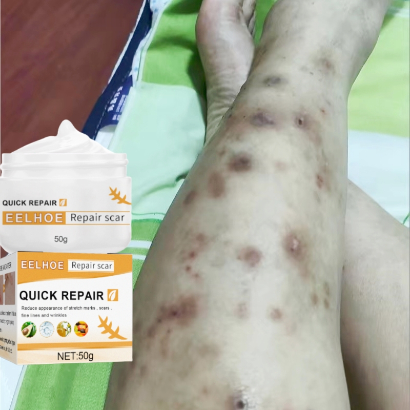 Krim hilangkan parut Hilangkan parut kaki Parut hitam Menghilangkan ...