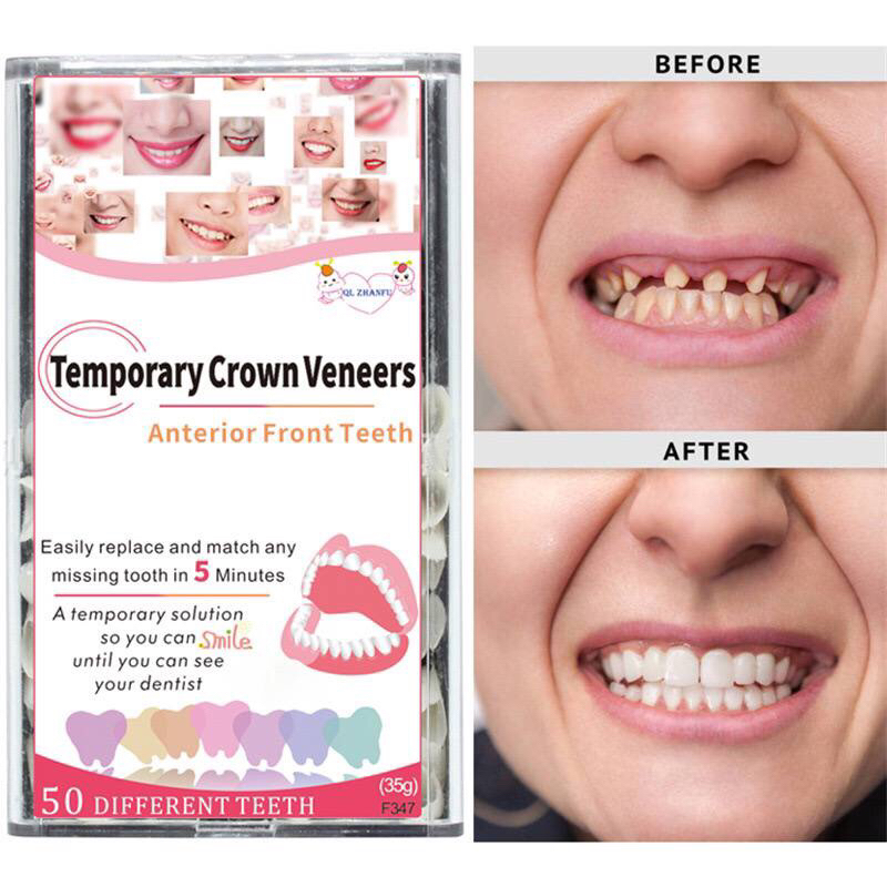 TEMPORARY CROWN VENEERS MOLAR TEETH Gigi palsu diy murah Membaiki ...