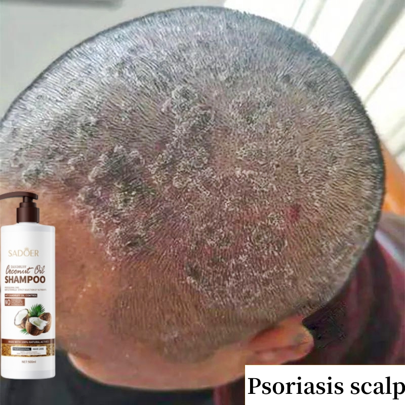 Shampoo kelemumur Rawat rambut kelemumur Kulit kepala gatal Psoriasis scalp kulit kepala kering ...